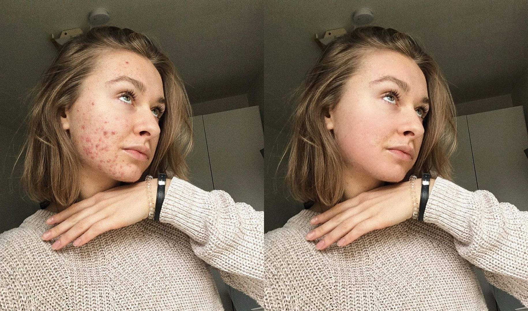 Face AR SDK v1.8: Improved lips segmentation, Acne Removal